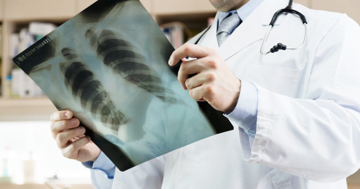 Pulmonary Fibrosis Stages